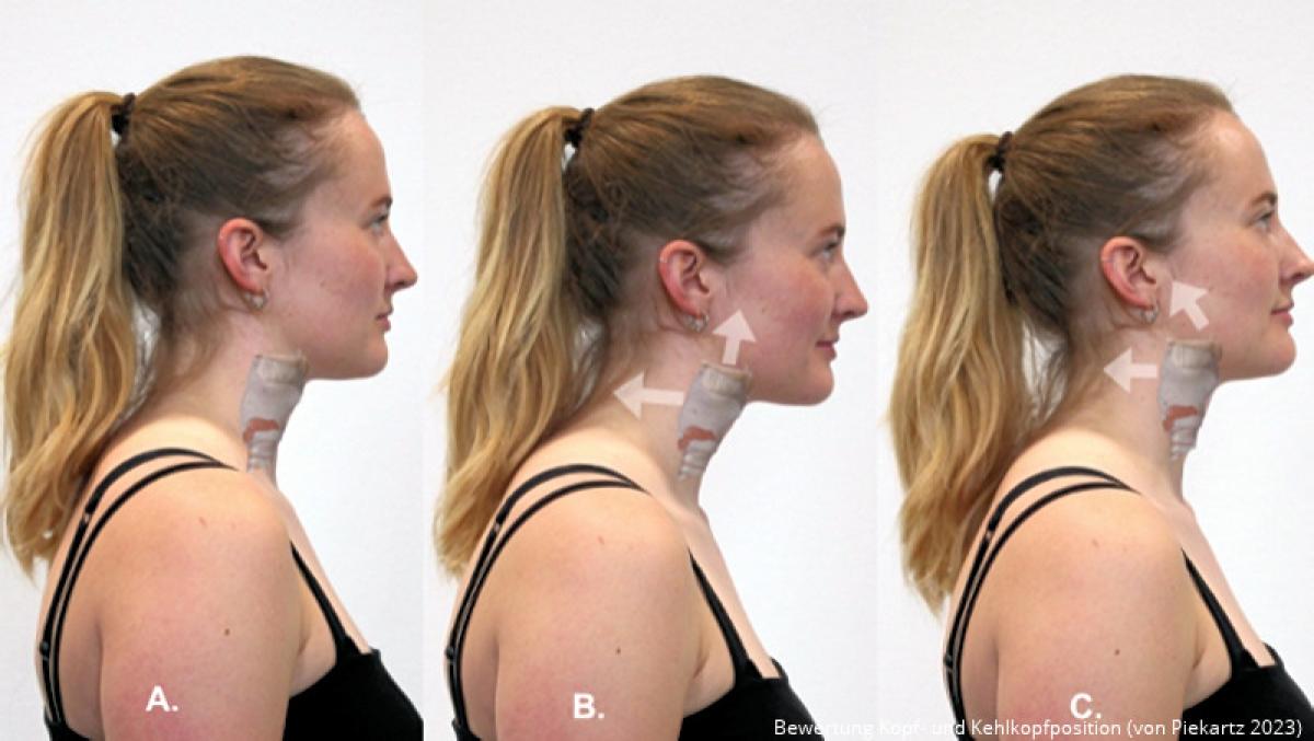 Functional Dysphonia | Crafta.org